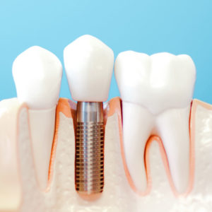 Dental Implant Restoration in Shawnee, KS | Crown Town Dental